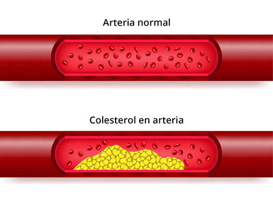 Síntomas del colesterol alto | ArmolipidPLUS